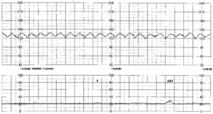 SIGNIFICANCE OF A SINUSOIDAL FETAL HEART RATE (FHR) PATTERN – Barber ...